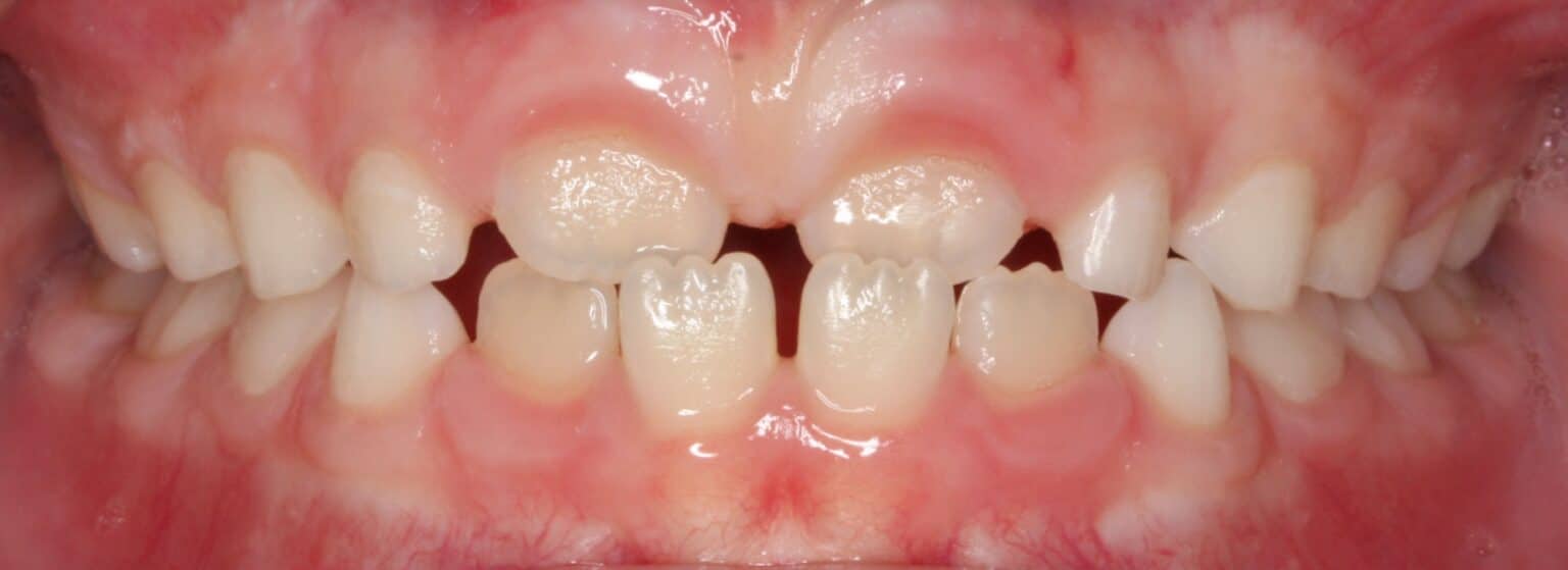 Common Orthodontic Problems Salem NH