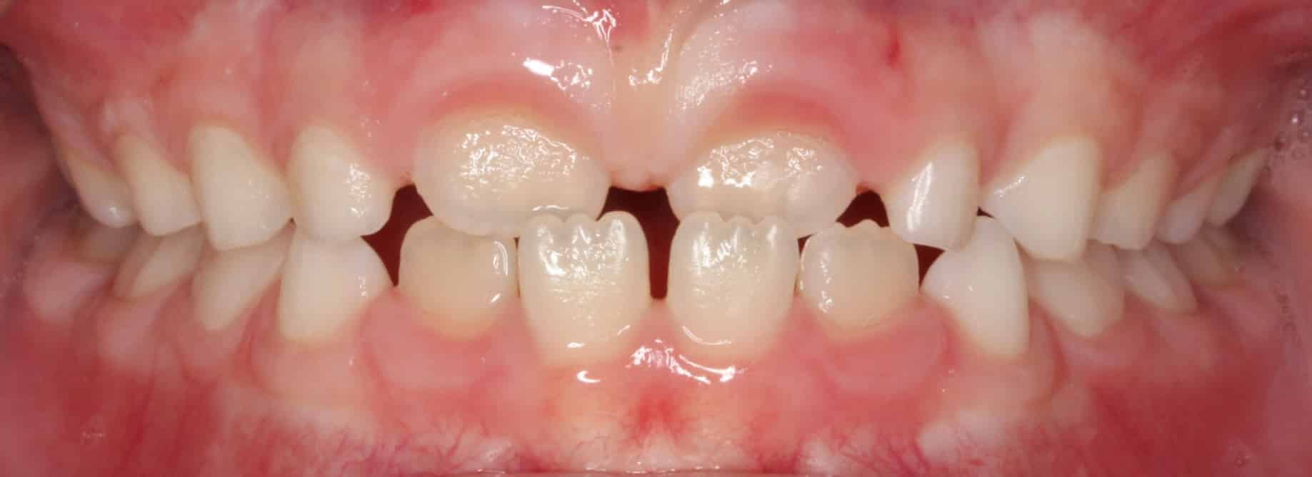 Common Orthodontic Problems Salem NH