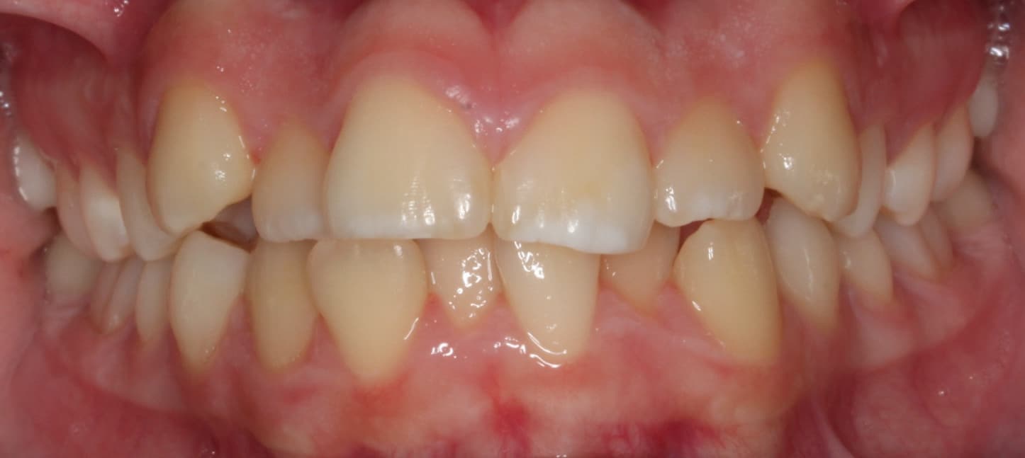 Common Orthodontic Problems Salem NH