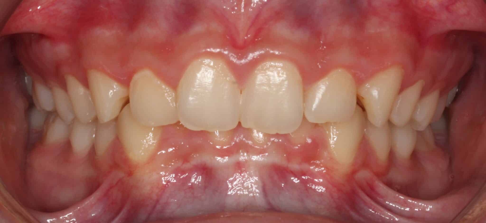 Common Orthodontic Problems Salem NH