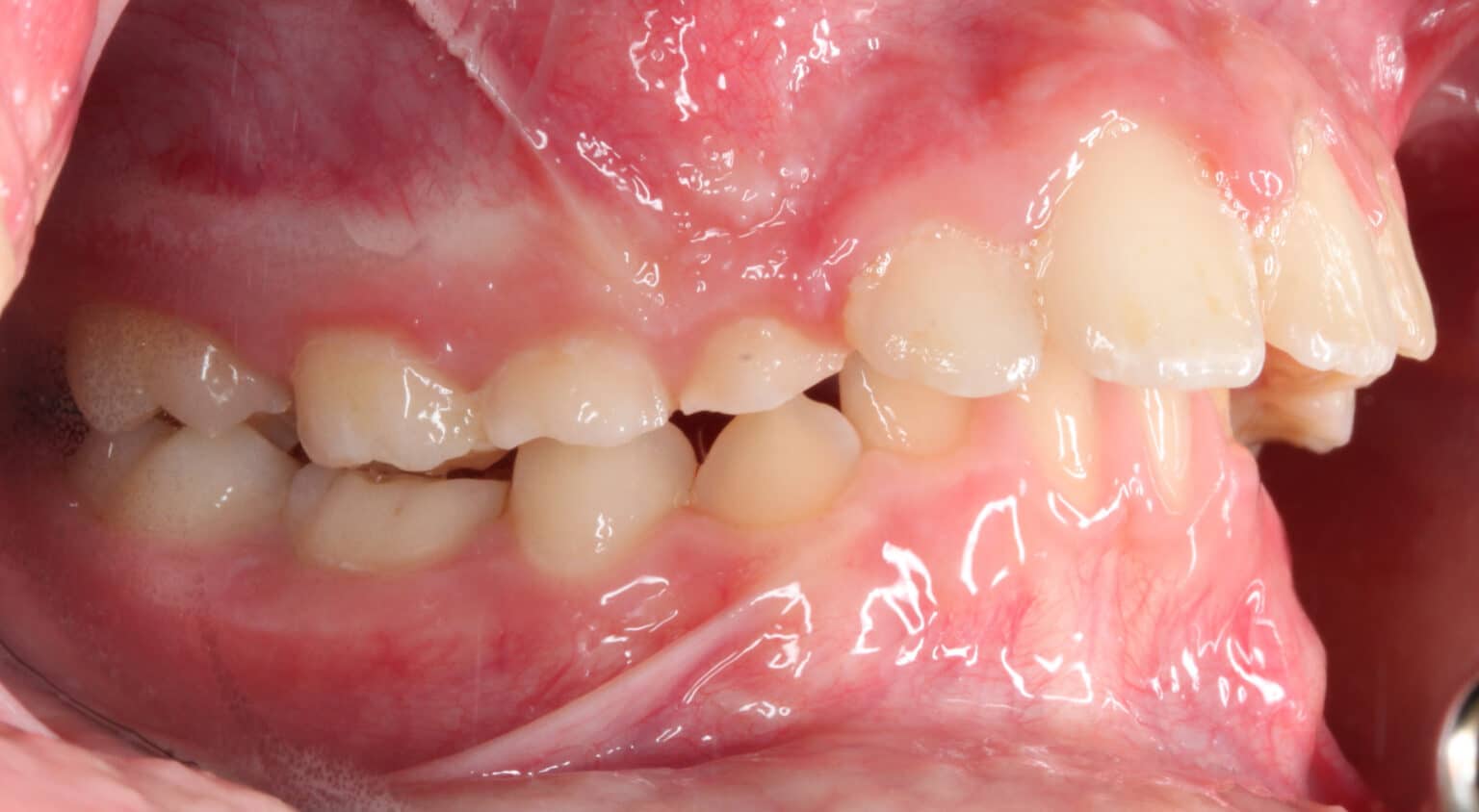 Common Orthodontic Problems Salem NH