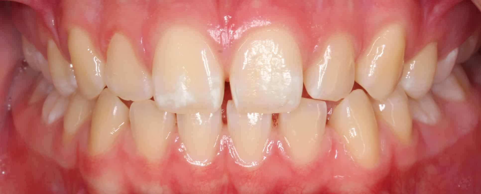 Common Orthodontic Problems Salem NH